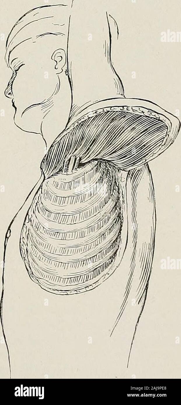 Thoracotomy hi-res stock photography and images - Alamy