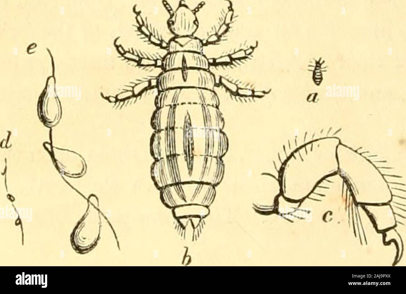 Phthiriasis hi-res stock photography and images - Alamy