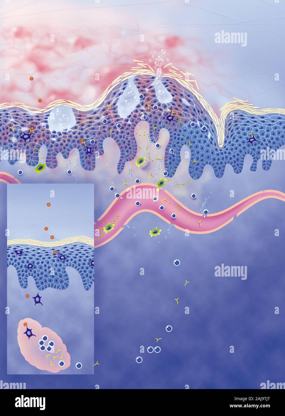 Cutaneous dermatitis hi-res stock photography and images - Alamy