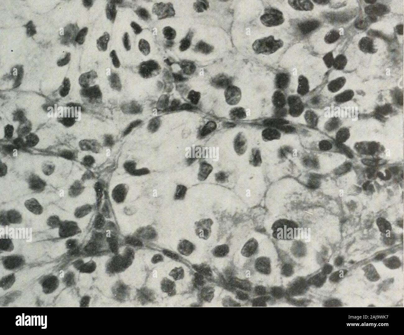 Annals of surgery . Fig. 3.—Case XI: Microphotograph of a section from ...