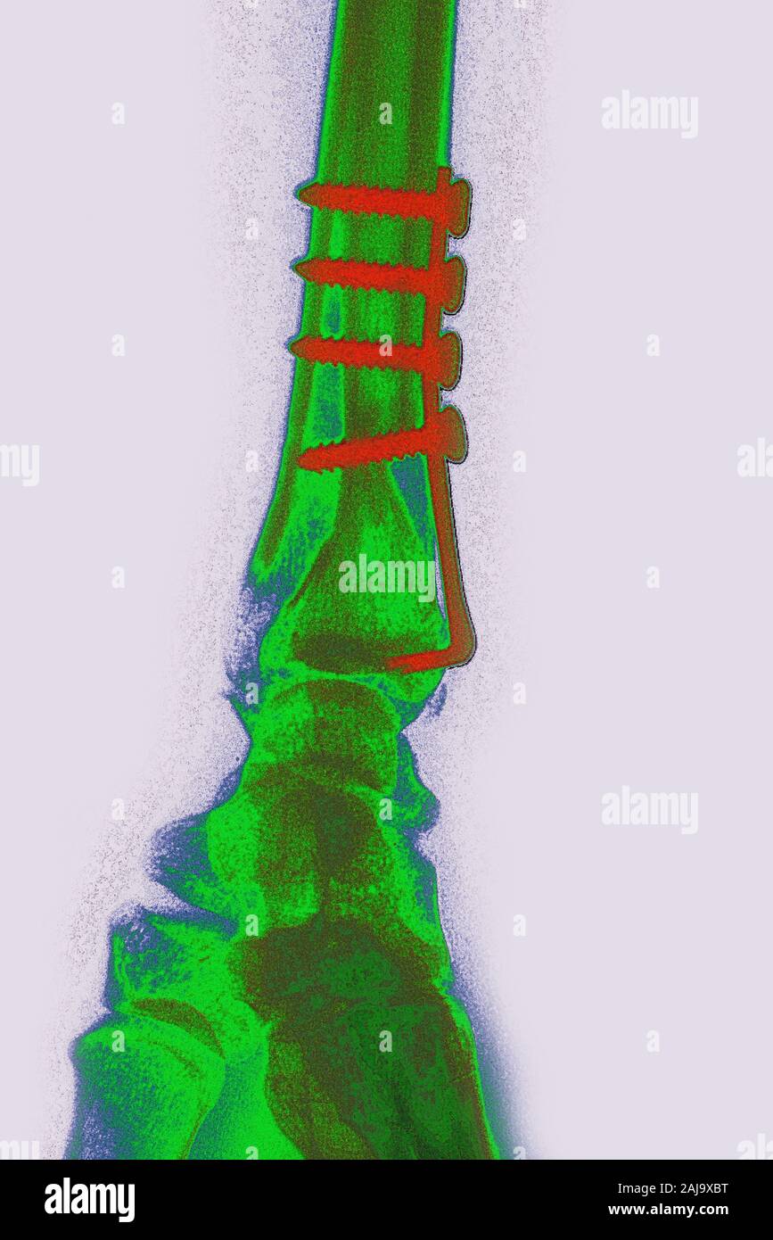 Osteosynthesis on radius Stock Photo - Alamy