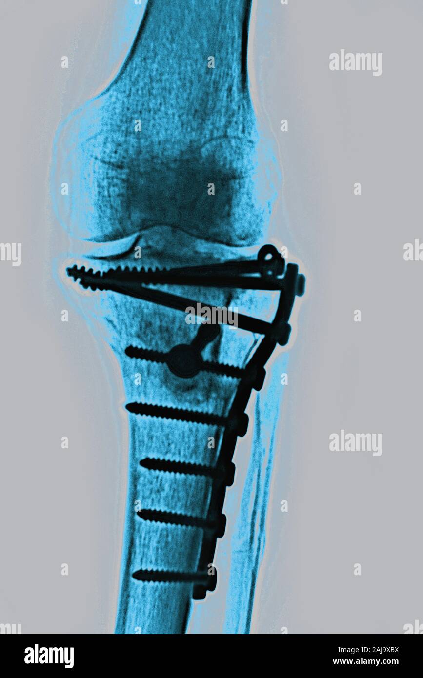 Tibia x ray fracture hi-res stock photography and images - Alamy