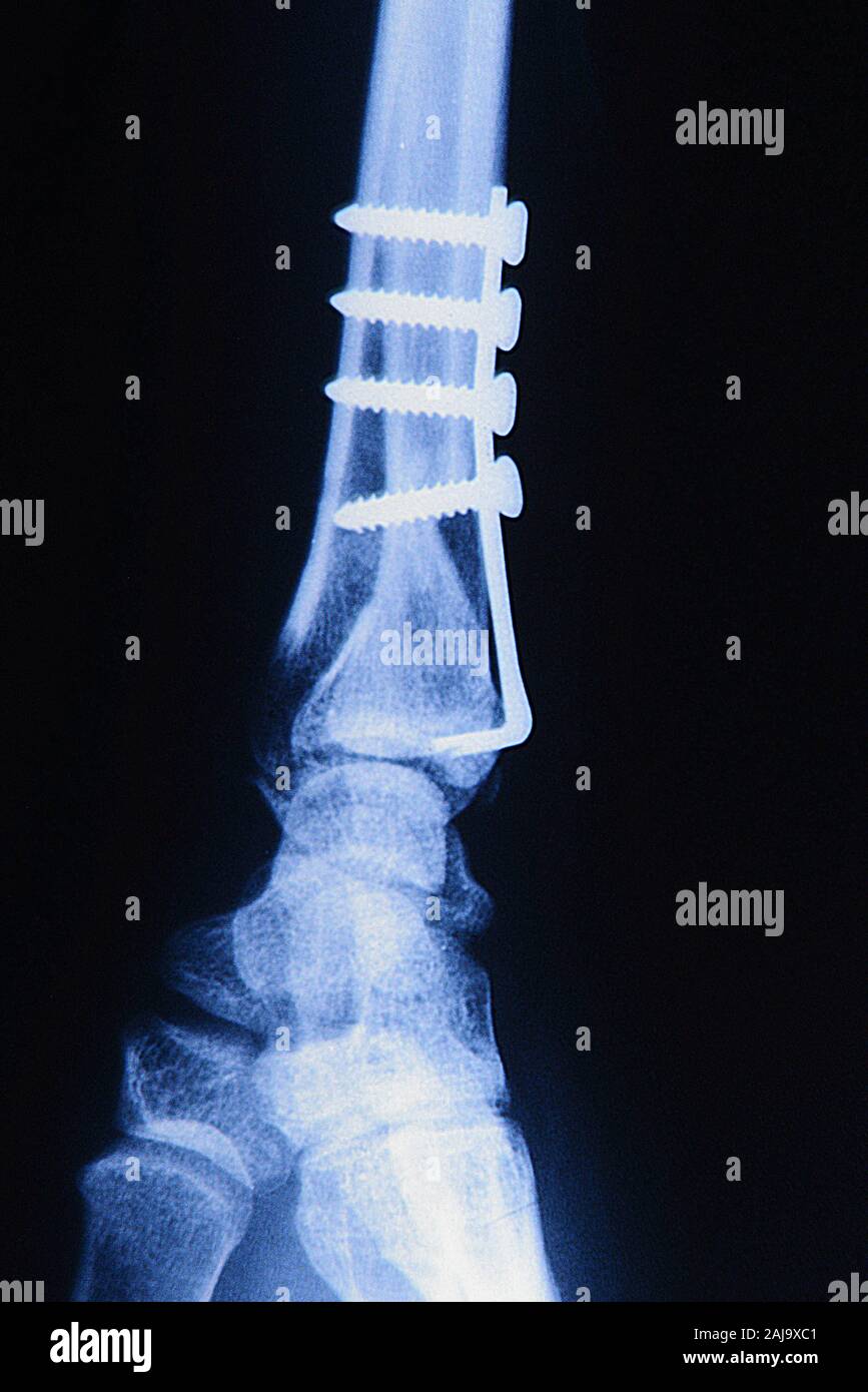 Osteosynthesis on radius Stock Photo - Alamy