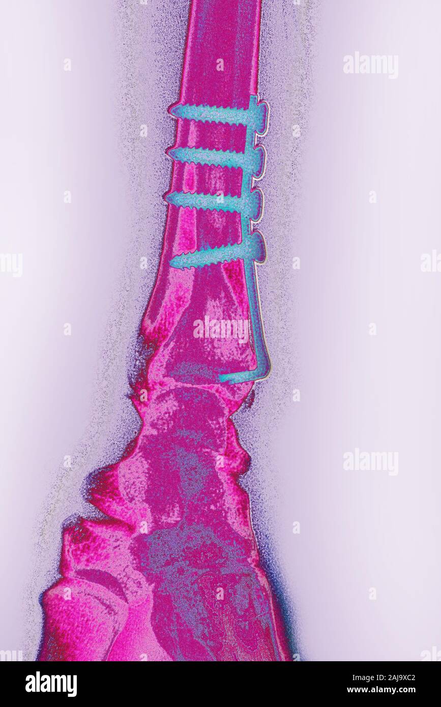 Radius fracture plate hi-res stock photography and images - Alamy