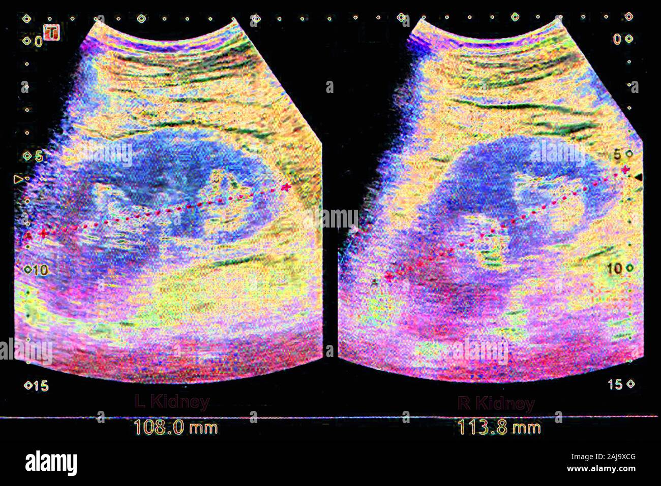 Ultrasound kidney renal hi-res stock photography and images - Alamy