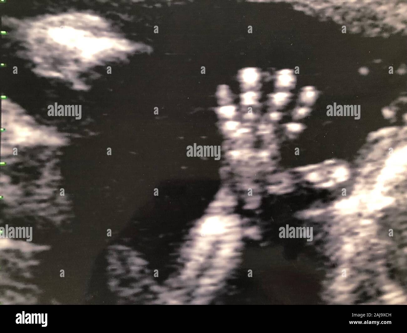 échographie foetale hi-res stock photography and images - Alamy