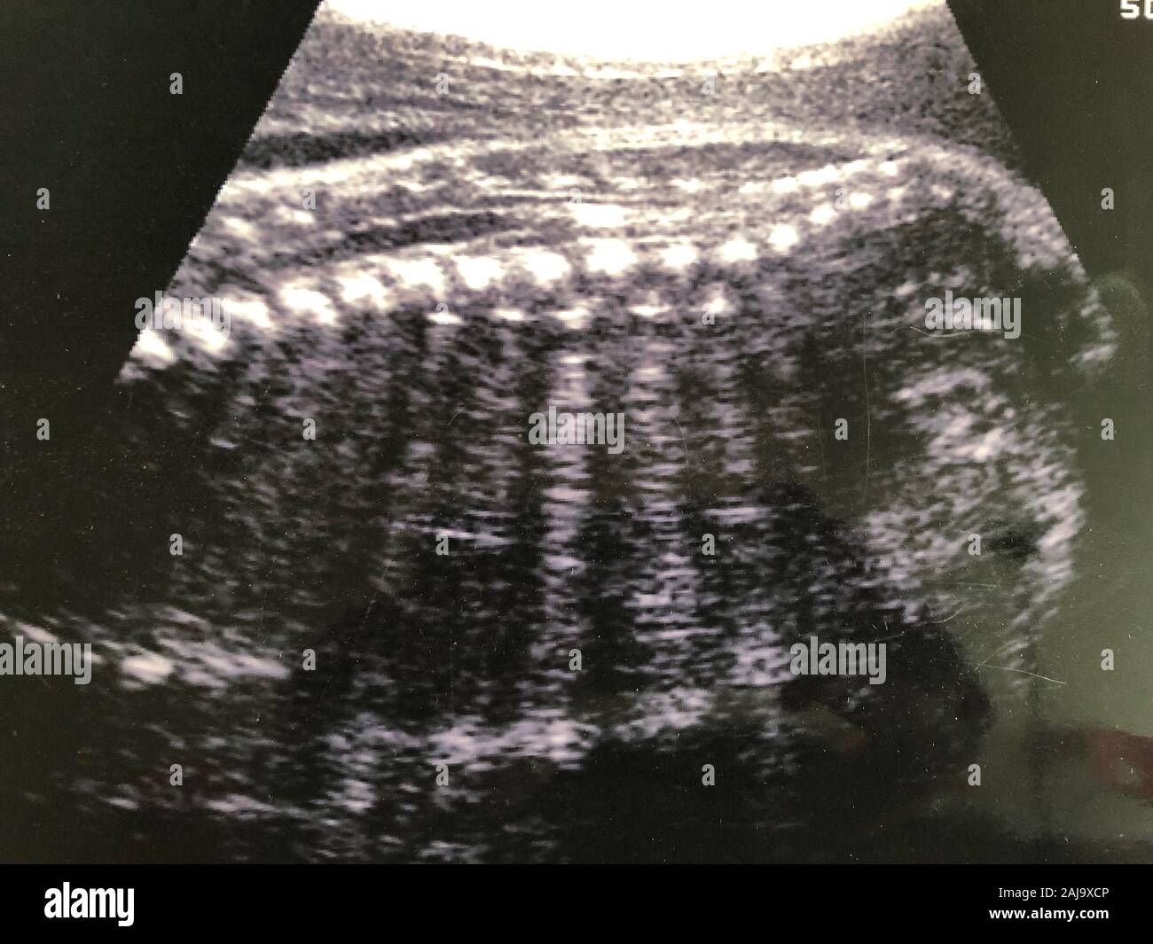 Fetal Ultrasound On Ribs Nomograms Of The Fetal Thymus For Clinical