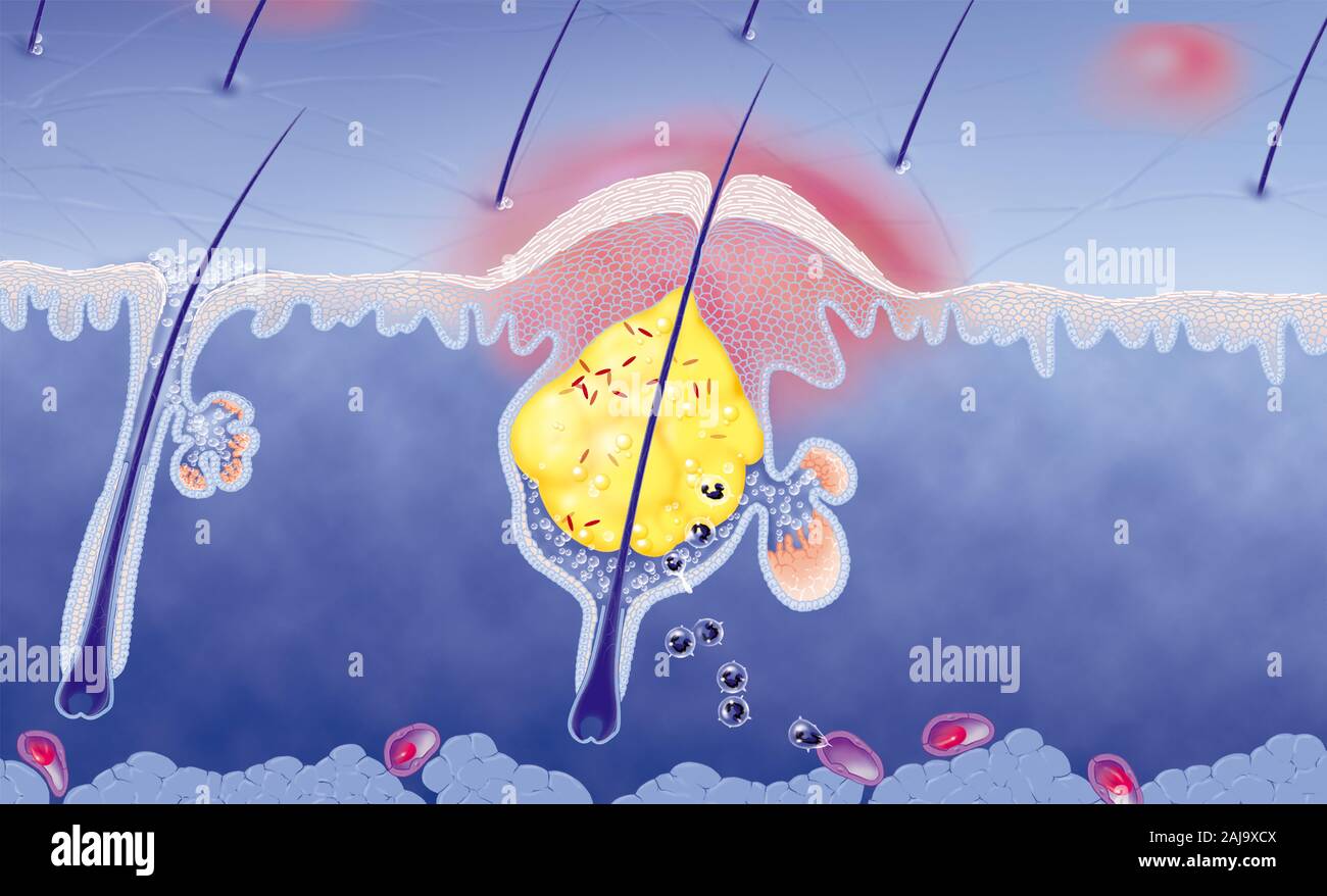 Acnes hi-res stock photography and images - Alamy