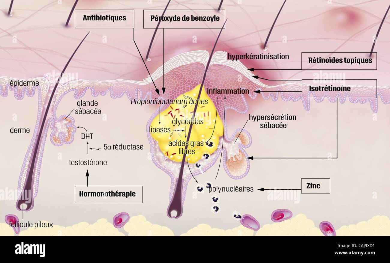 Propionibacterium acnes hi-res stock photography and images - Alamy