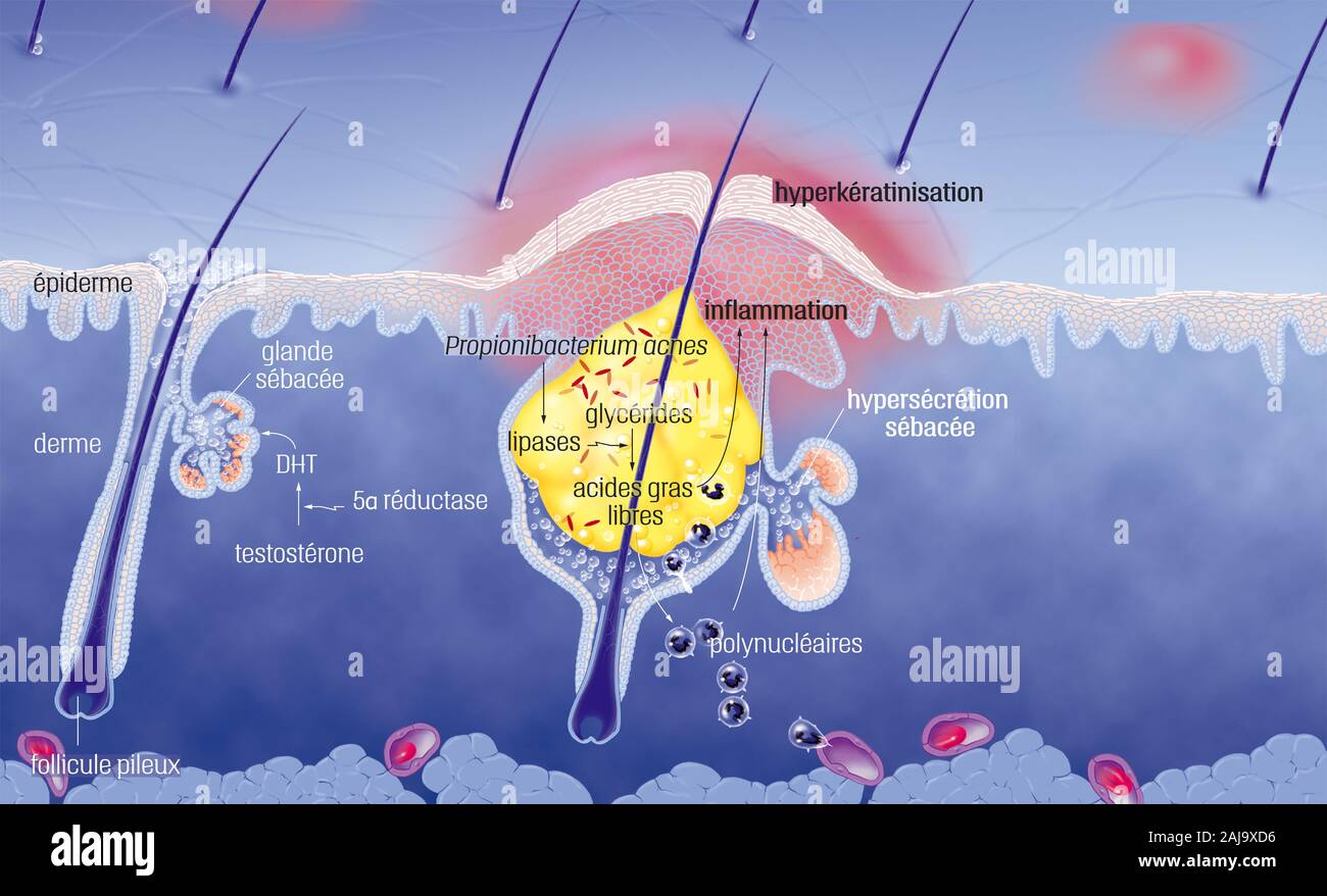 Propionibacterium acnes hi-res stock photography and images - Alamy