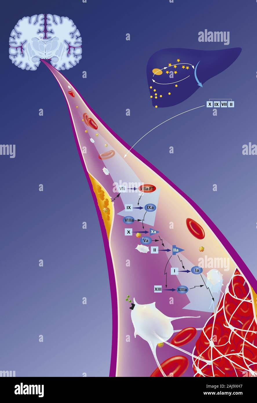 Blood clot brain hi-res stock photography and images - Alamy