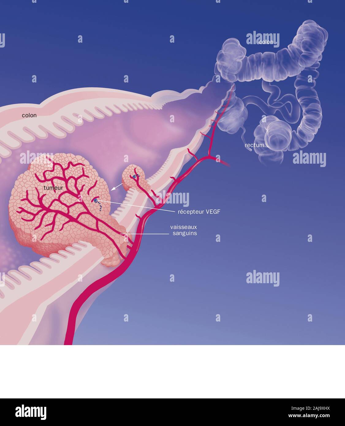 Rectal cancer cell hi-res stock photography and images - Alamy