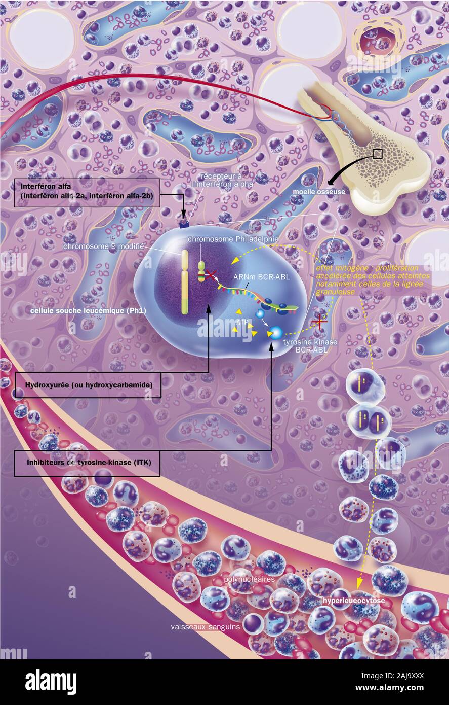 Chronic myeloid leukemia, cml Stock Photo - Alamy