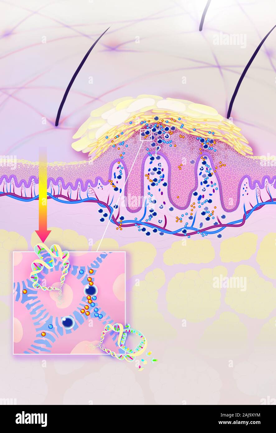 Psoriasis in section, erythematous-squamous plaque, hyperkeratosis ...