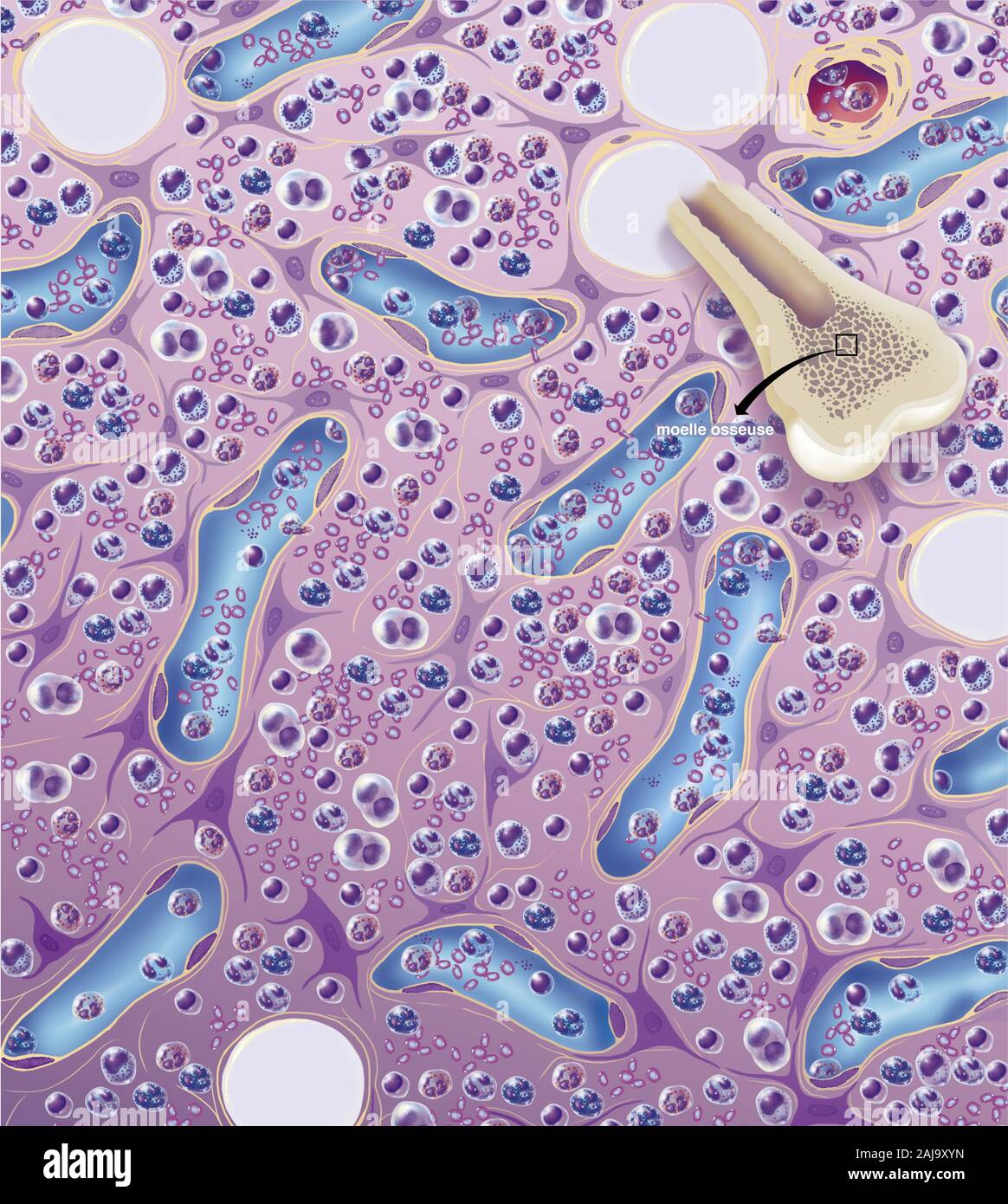 Proliferation of leukemic cells in the bone marrow, leukocytosis. In ...