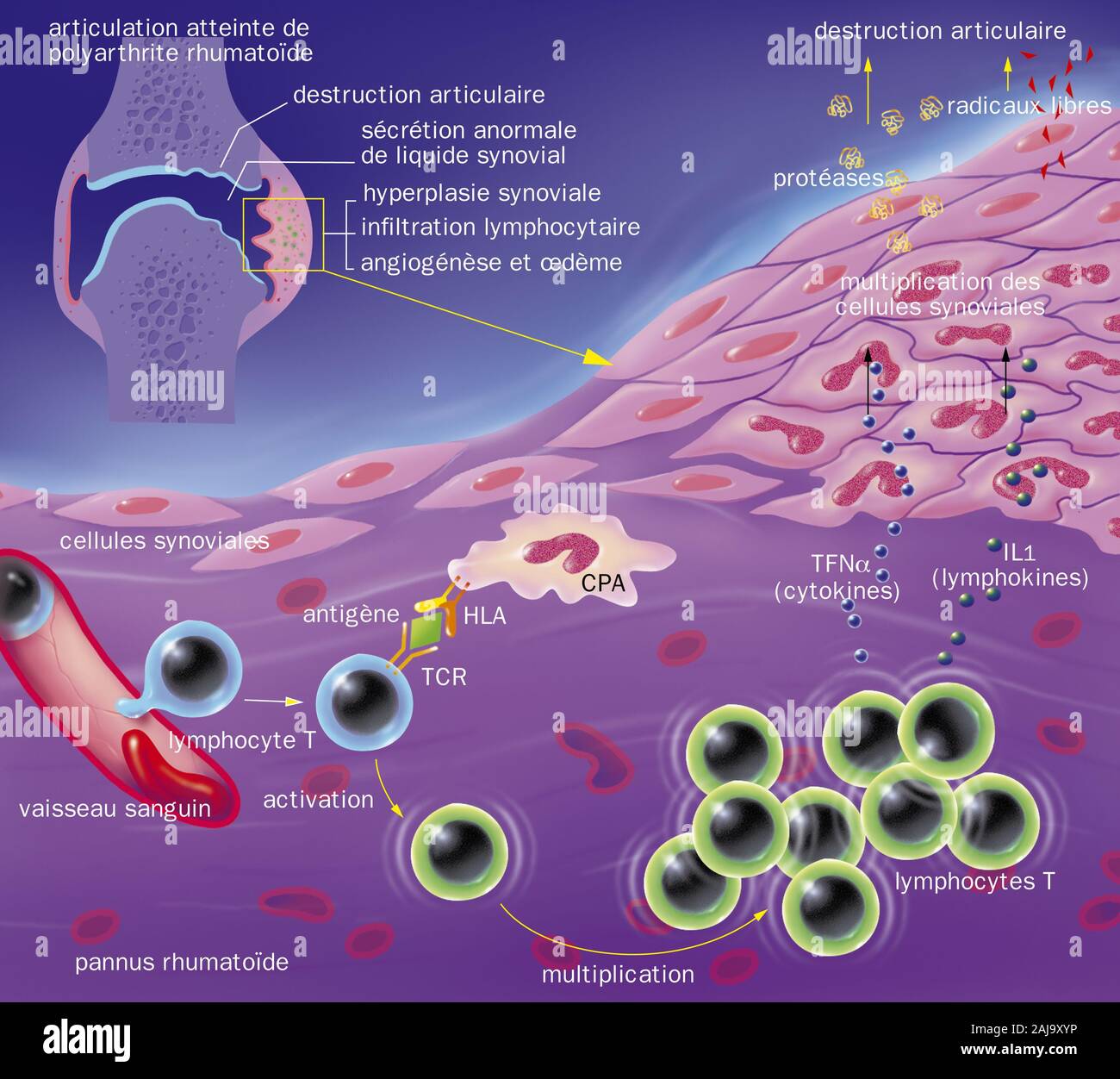 Joint destruction process, synovial hyperplasia, angiogenesis, edema ...