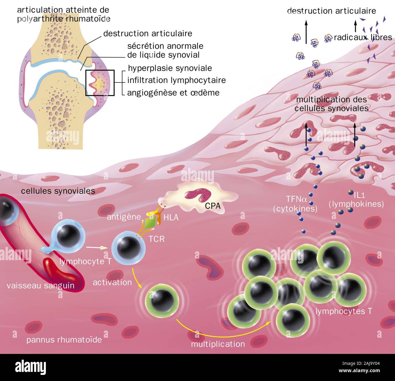 Joint destruction process, synovial hyperplasia, angiogenesis, edema, lymphocyte infiltration ...