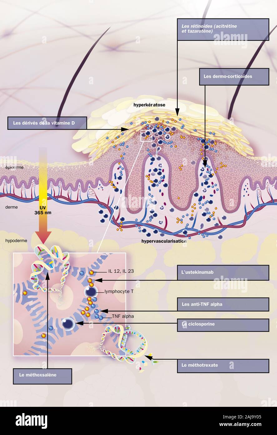 Psoriasis in section, erythematous-squamous plaque, hyperkeratosis ...