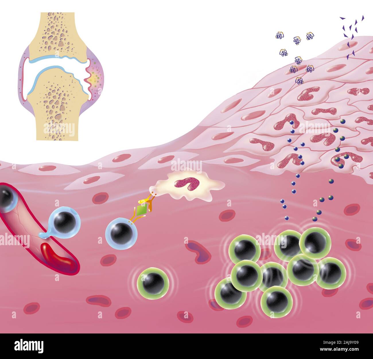 Joint destruction process, synovial hyperplasia, angiogenesis, edema ...