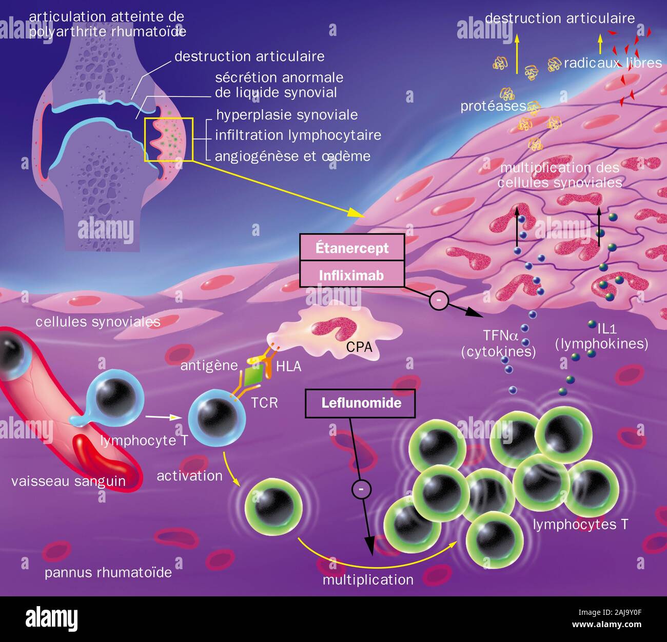 Infiltrative Process