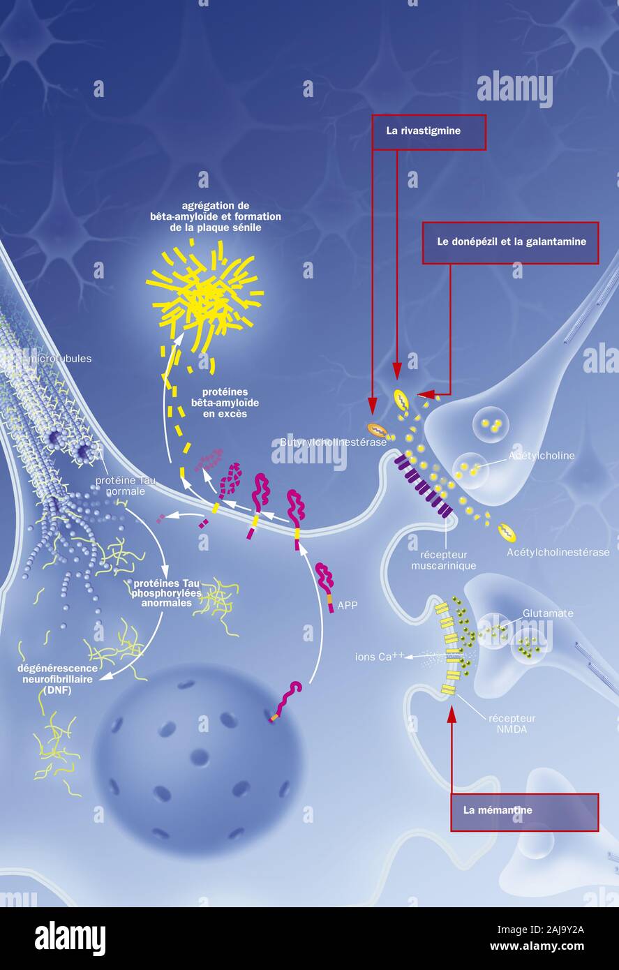 Neuron with neurofibrillary degeneration process, senile plaque ...