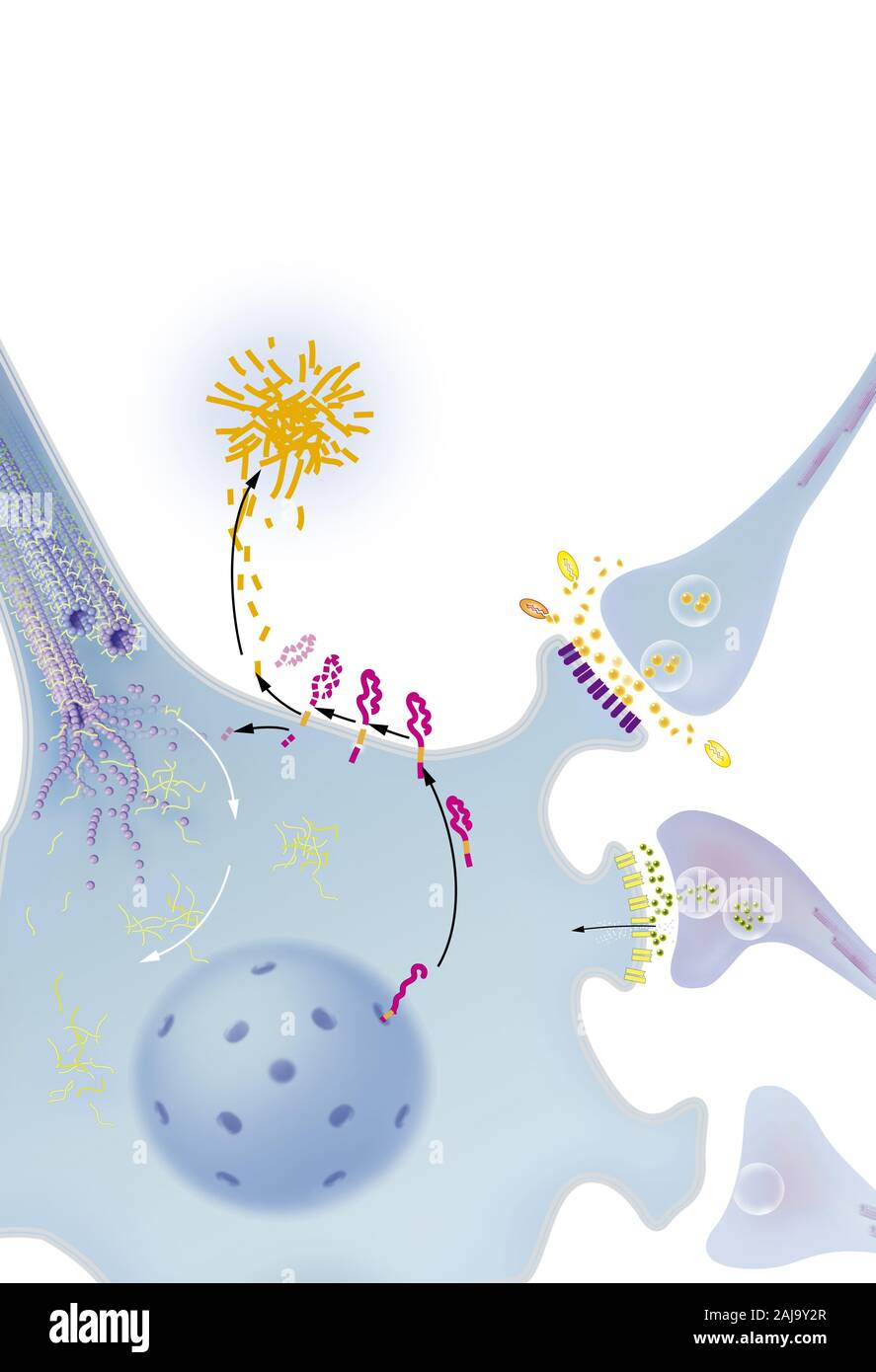 Neuron with neurofibrillary degeneration process, senile plaque ...