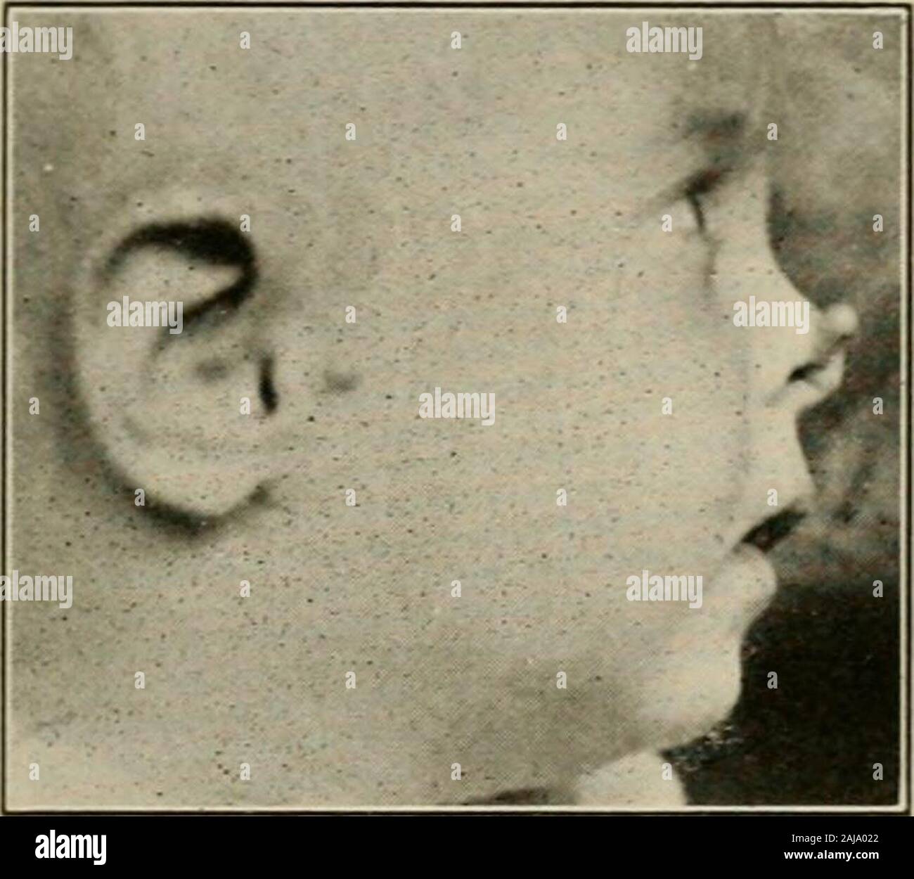 Congenital ear deformity hi-res stock photography and images - Alamy