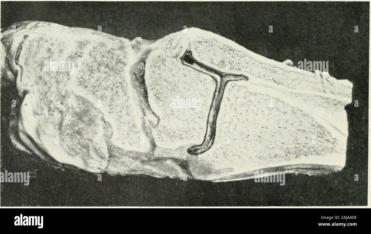 Bulky dressing hi-res stock photography and images - Alamy