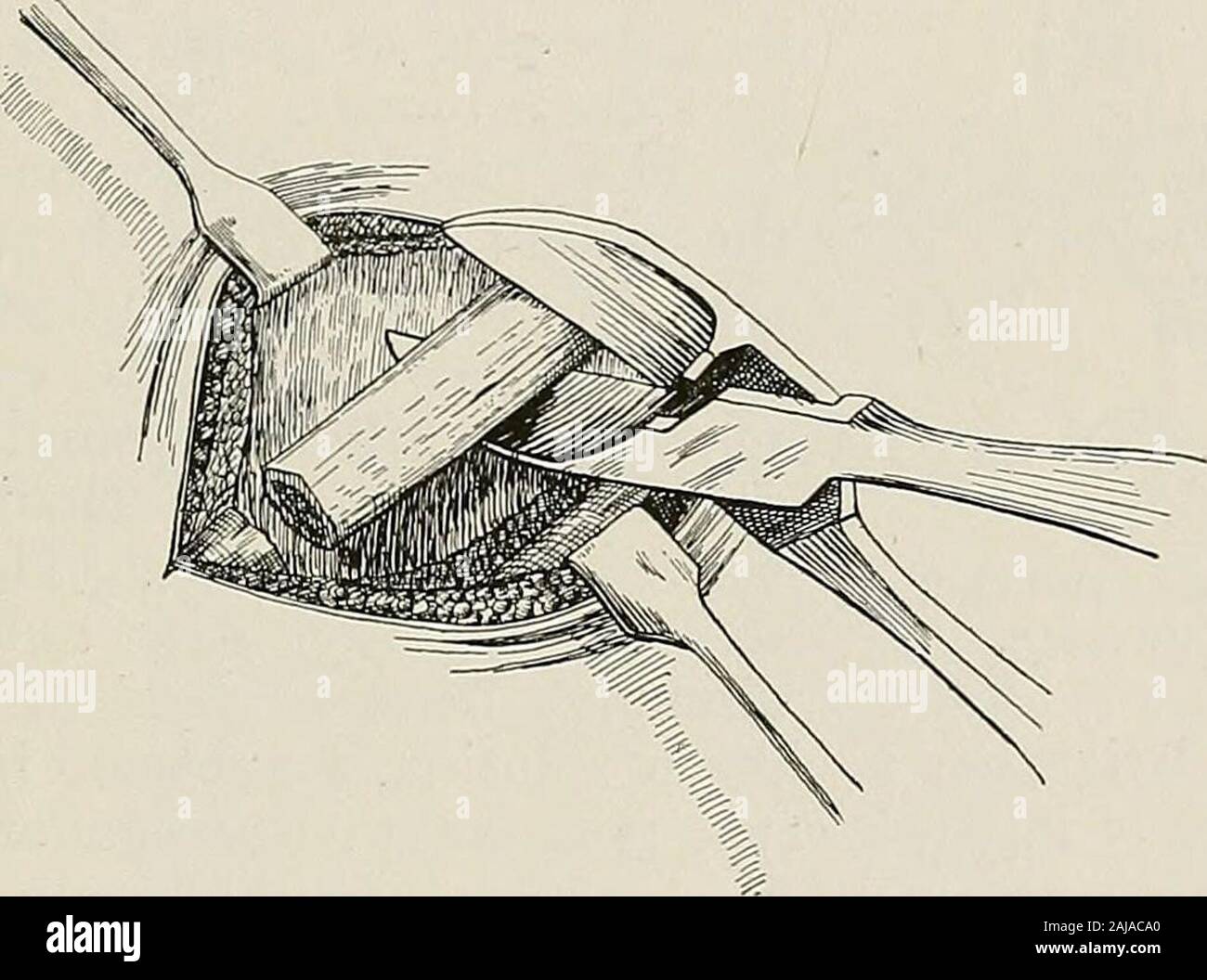 Chest tube drain hi-res stock photography and images - Alamy