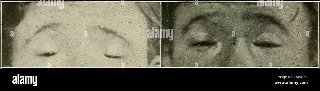 Palpebral conjunctiva hi-res stock photography and images - Alamy