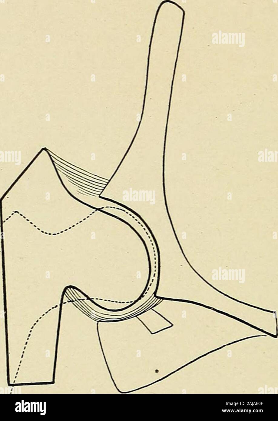 A treatise on orthopedic surgery . d. The gait is ex-tremely awkward ...