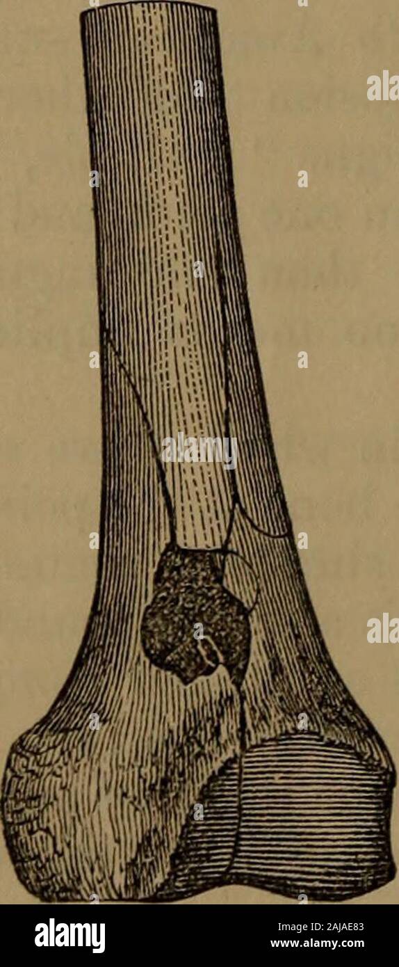 Oblique bone fracture hi-res stock photography and images - Alamy