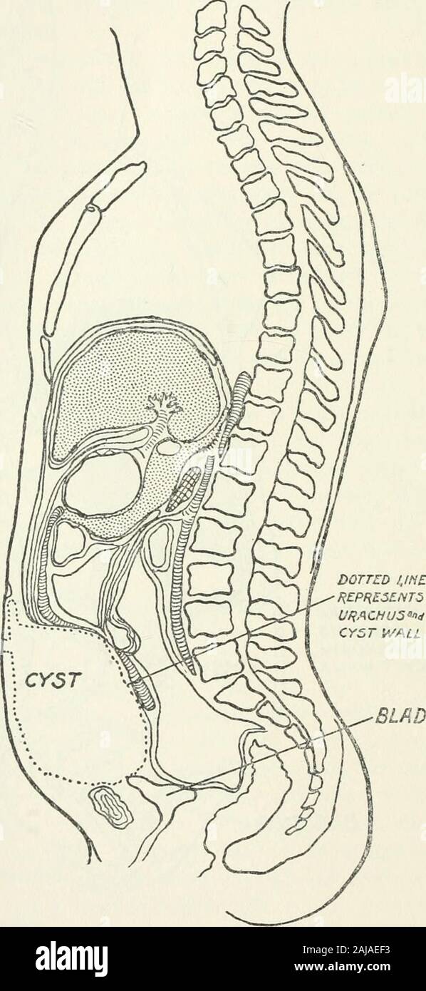 Bladder cyst hi-res stock photography and images - Alamy