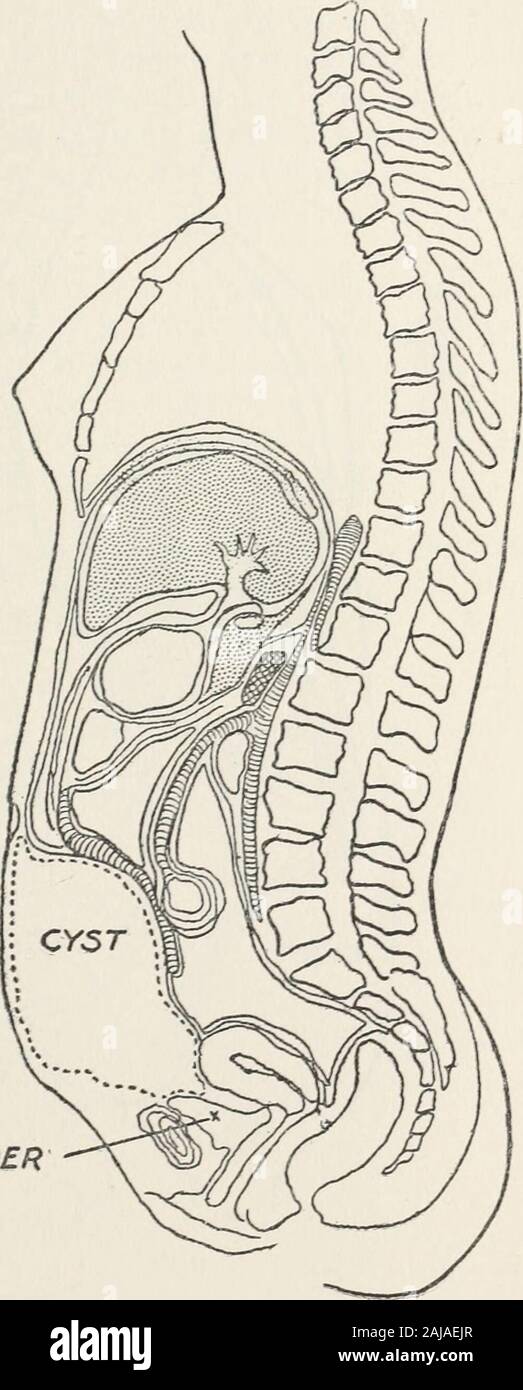 Annals of surgery . a two by four and one-half inches was bare of peri ...