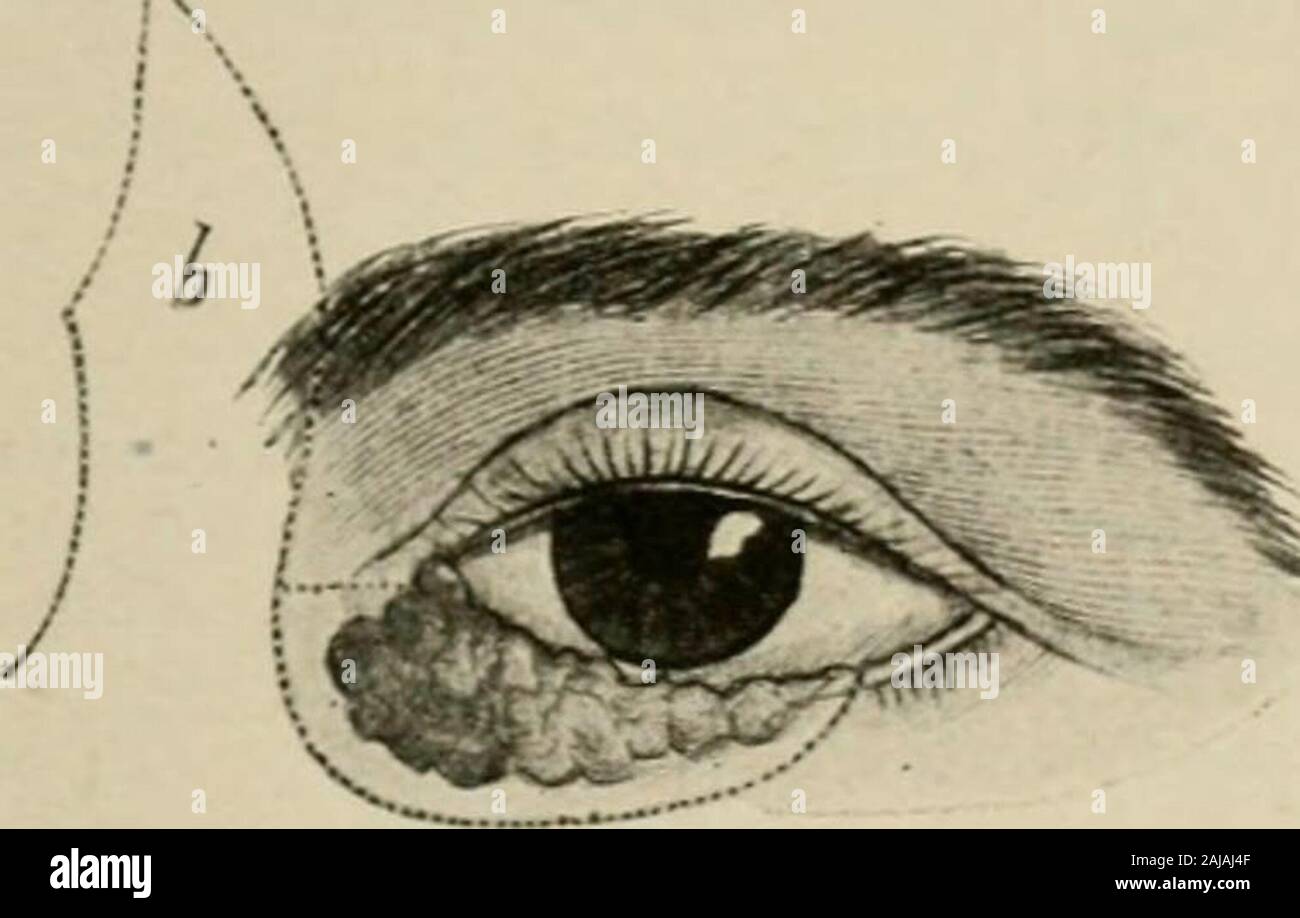 Beard flap of skin hi-res stock photography and images - Alamy