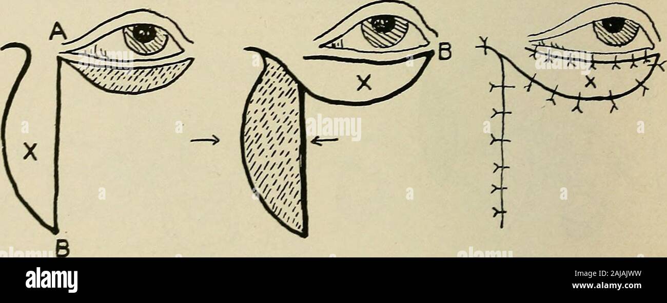 Sutured eyelid hi-res stock photography and images - Alamy