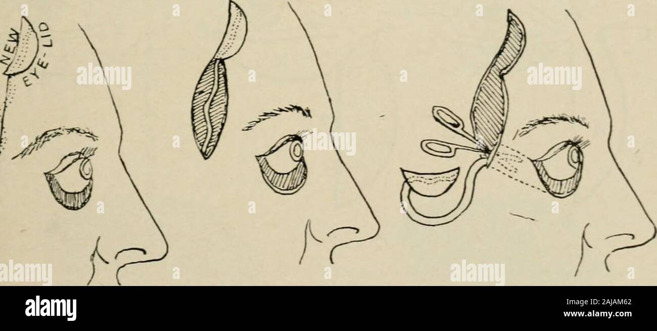 Plastic surgery; its principles and practice . Fig. 351.—Gibsons ...