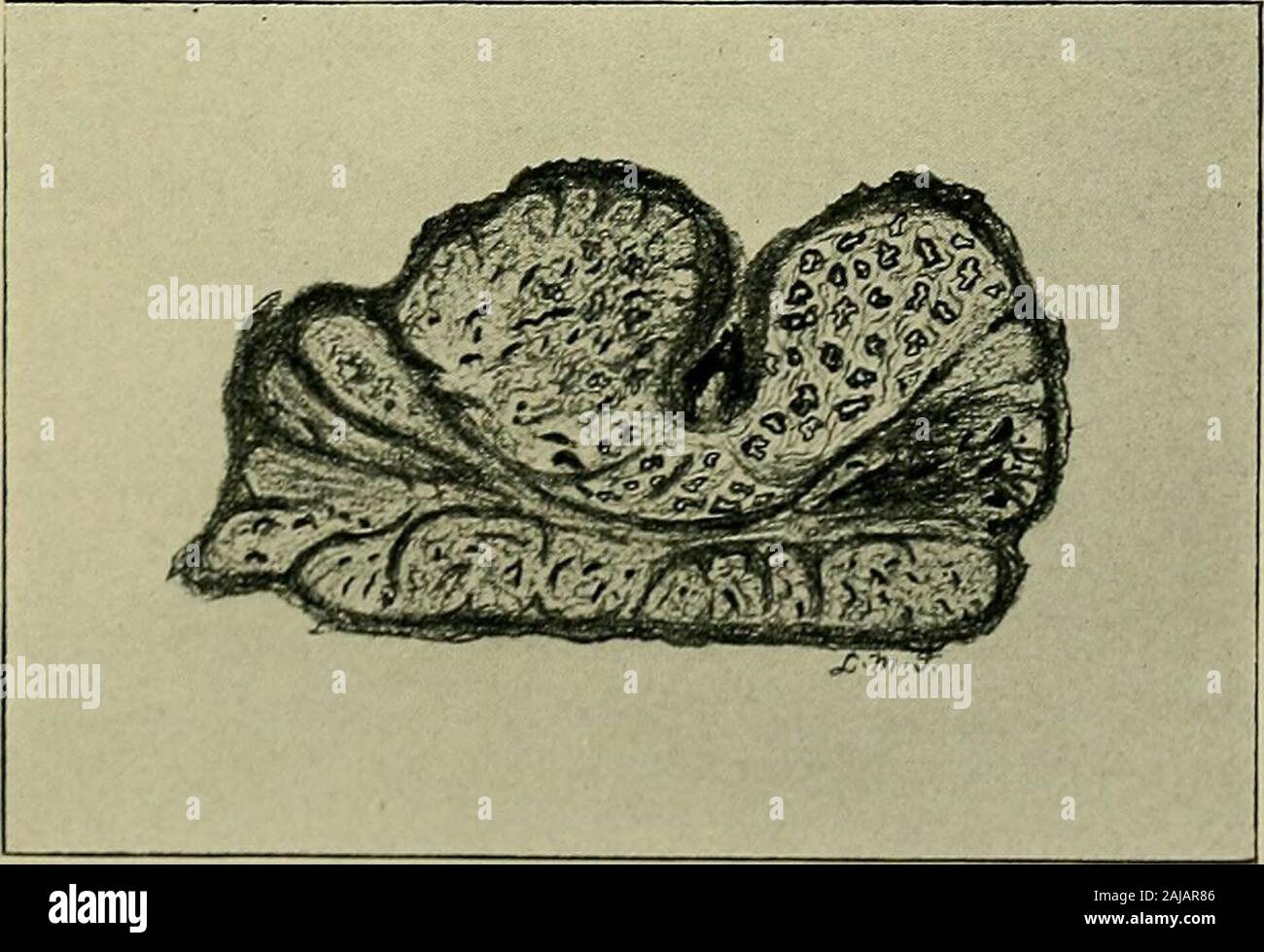 Enlarged lip hi-res stock photography and images - Alamy