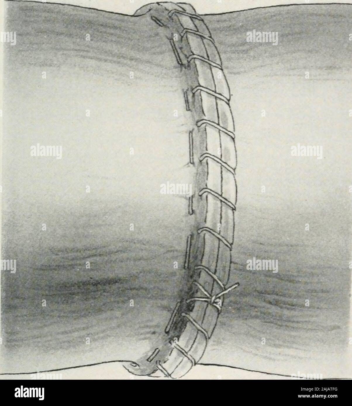 Annals of surgery . Fig. 4.—Suture of complete transverse woutul ; A ...