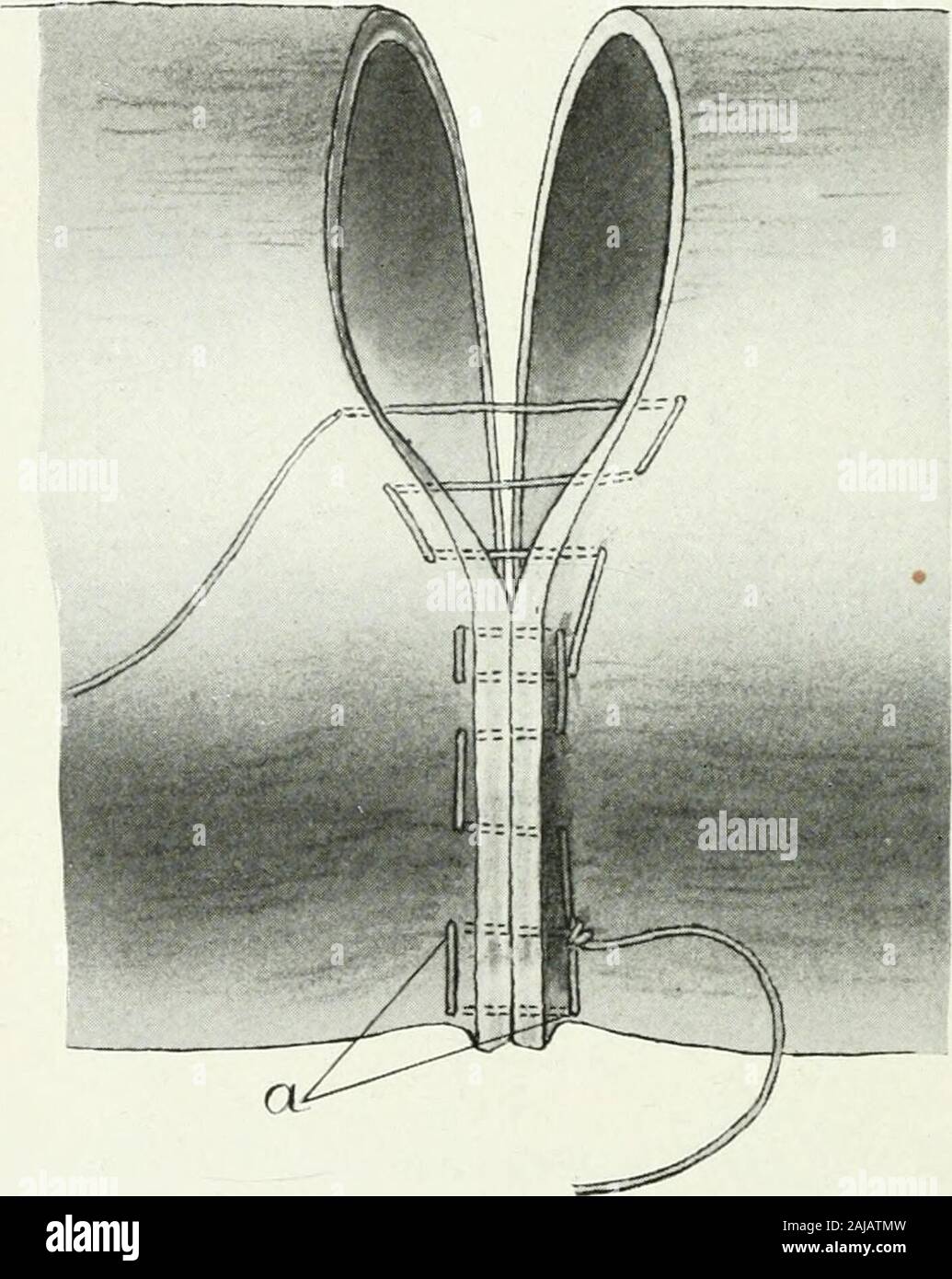 Annals of surgery . JL£, ^ LUutne.i^tJ^e^^ Jz^:i:.t^t^i-^S/2^a£,
