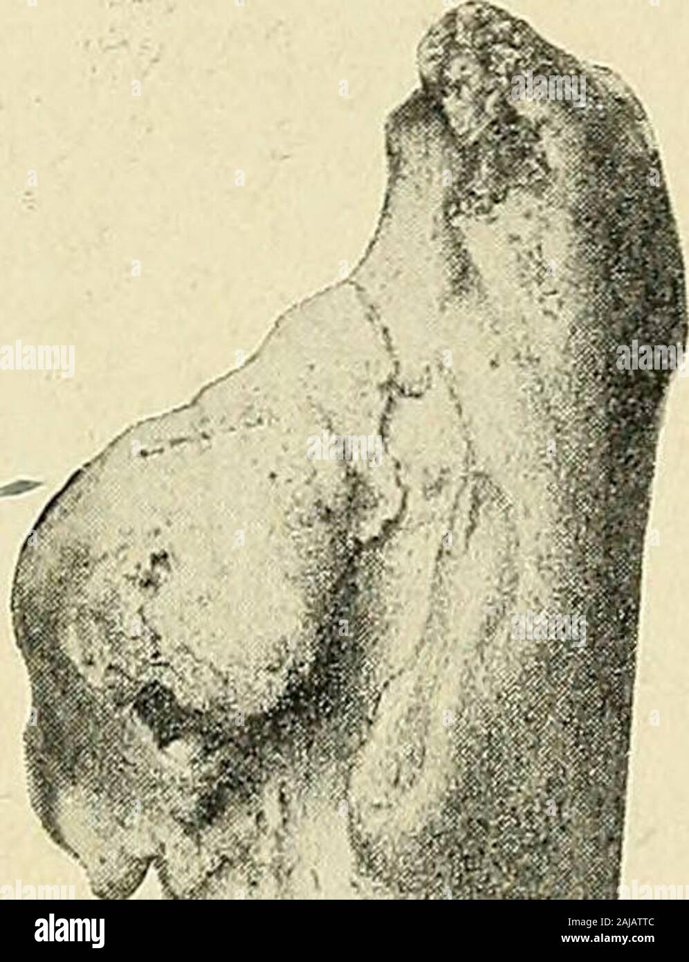 Congenital dislocation of the hip hi-res stock photography and images ...