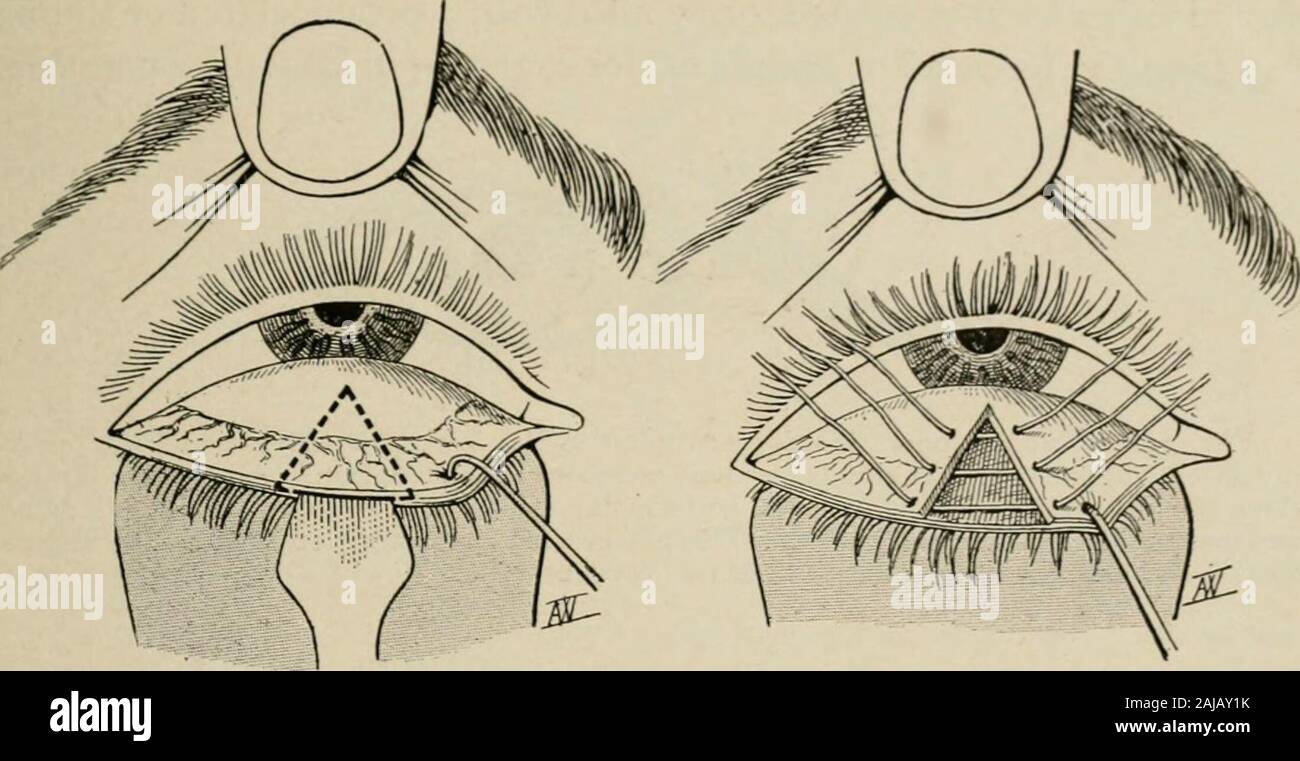 Plastic surgery; its principles and practice . Fig. 338.—Von Amons ...