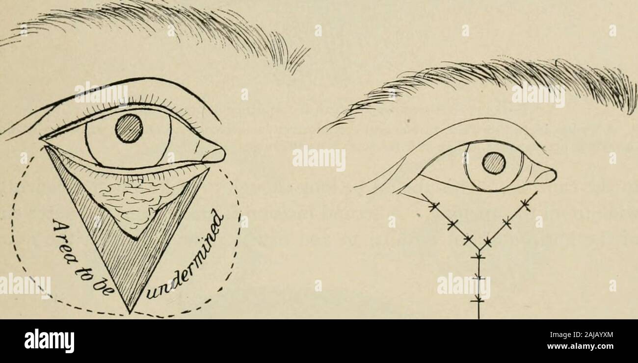 Plastic surgery; its principles and practice . hisincision a ...