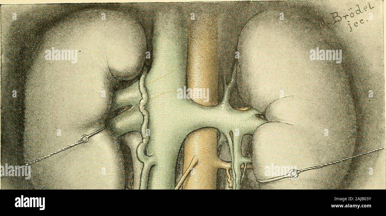 Operative gynecology : . Yxg 26 The Uterus Pulled Out Over the ...