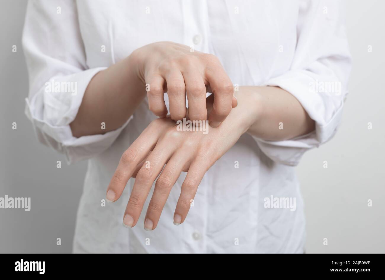 Signs of dermatitis and scabies. Woman scratches her hands. Skin ...