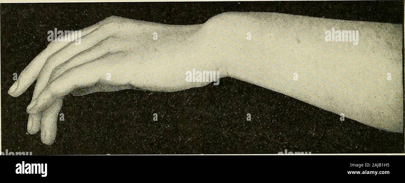 A treatise on orthopedic surgery . scribed byMadelung^ as spontaneous ...