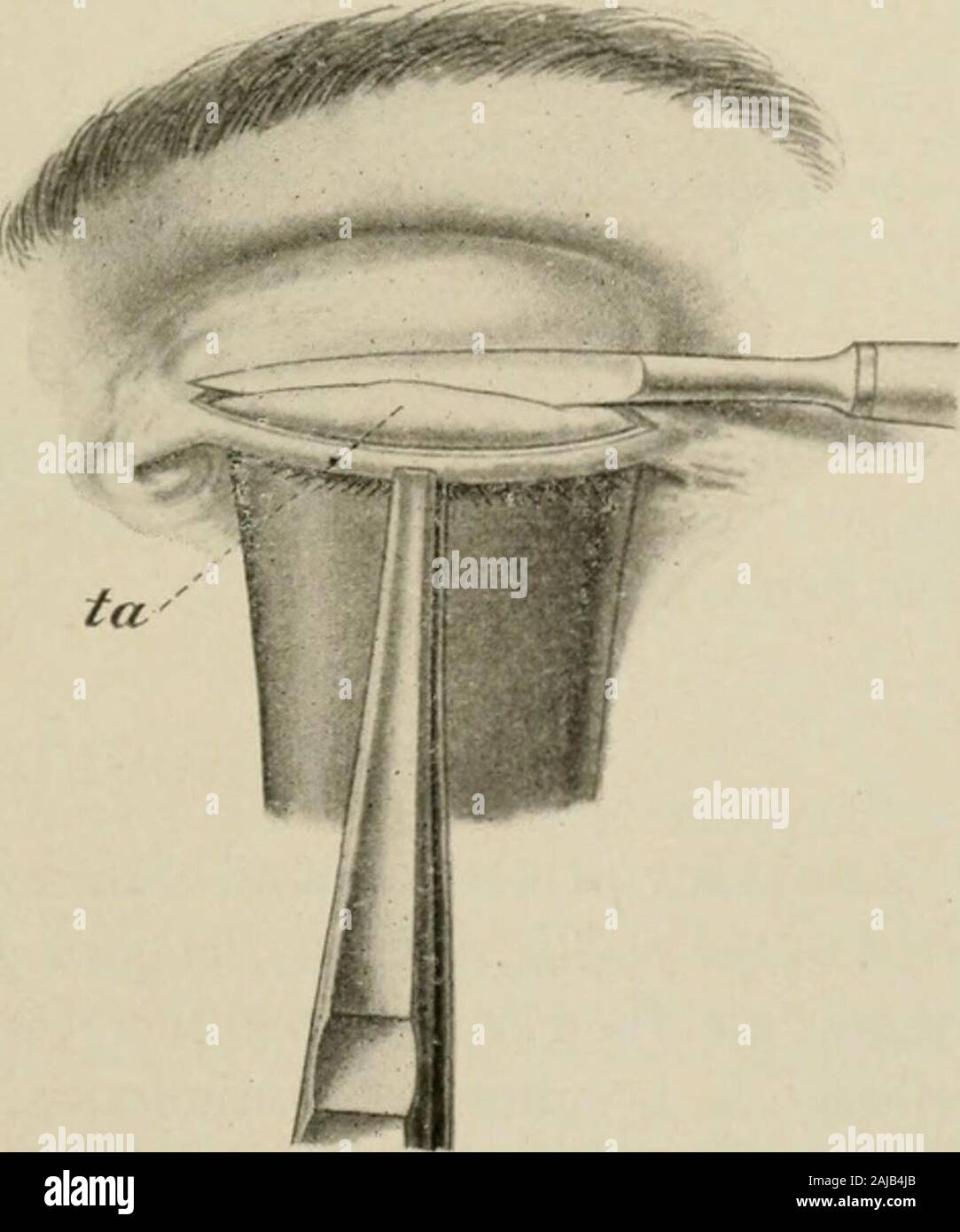 Plastic surgery; its principles and practice . Pig. 321.—Hotz ...