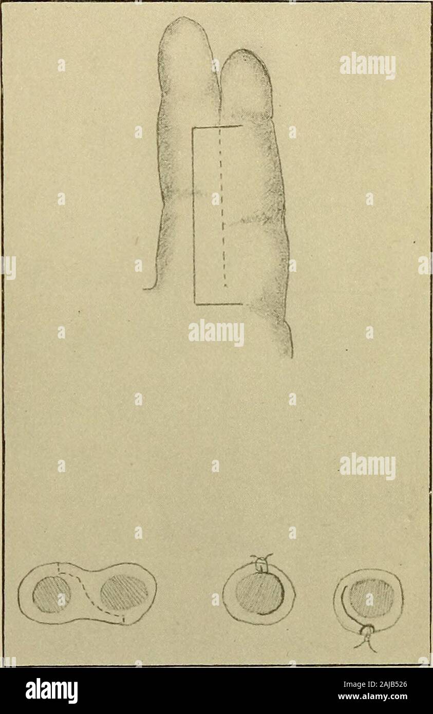 I limb digits hi-res stock photography and images - Alamy