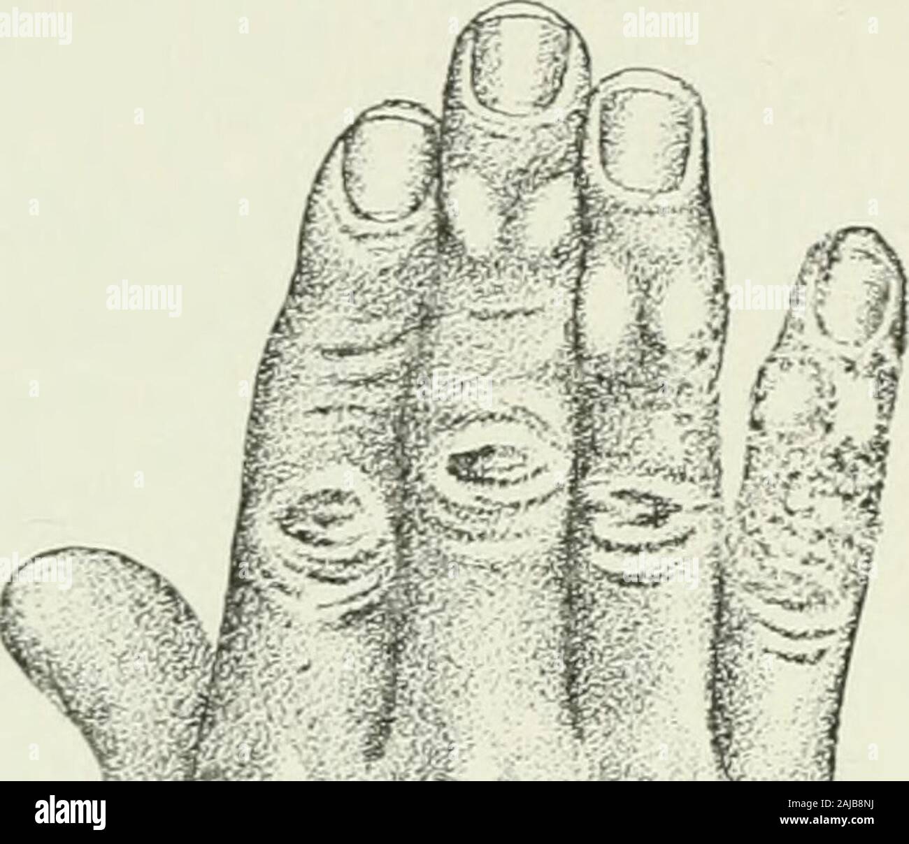 Attack of gout hi-res stock photography and images - Alamy