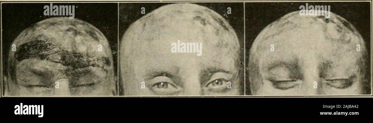 Plastic surgery; its principles and practice . Fig. 308.—Complete ...